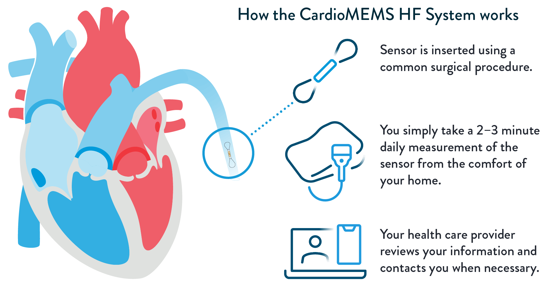 TEAM HF Clinical Trial Patient | Abbott